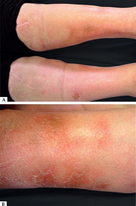 Nodular Vasculitis Associated With Lung Adenocarcinoma Pmc