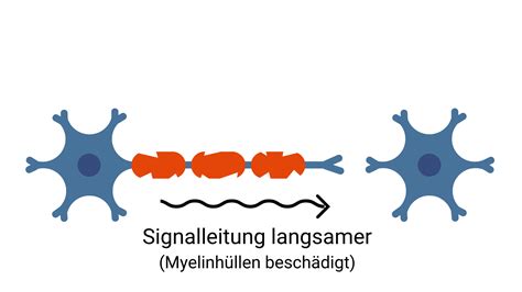 Was Ist Multiple Sklerose Dmsg Lv Sh