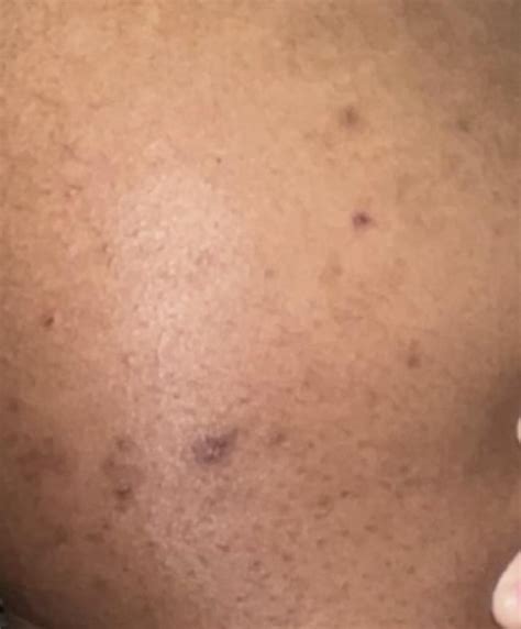 Acne Dark Acne Scars On Butt Reoccurring For Years Help Been Using
