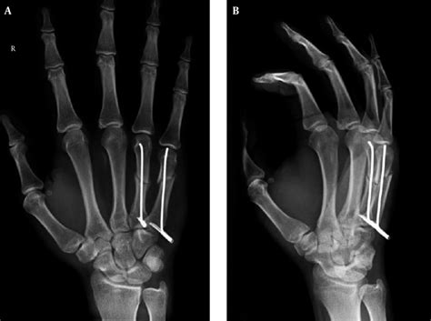 Update On The Treatment Of Metacarpal Fractures