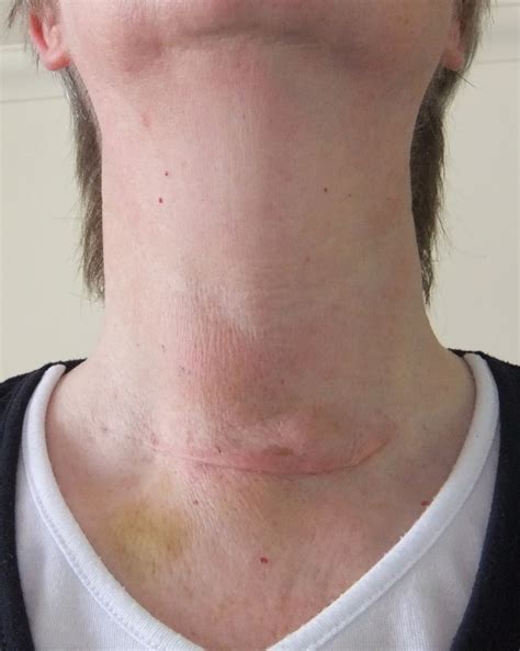 Partial Thyroidectomy Before And After Photos Partial Thyroidectomy Before And After Photos