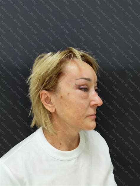 Подтяжка лобно височной области через проколы в волосистой части головы в сочетании с круговой