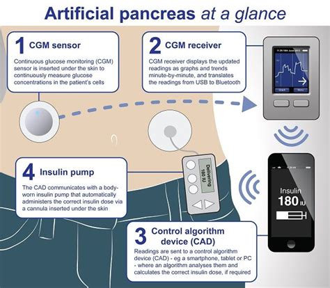 diabetesmine provides a primer to what s happening with the so called artificial pancreas
