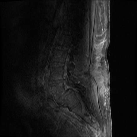 Differential Diagnosis Of Spinal Epidural Abscess