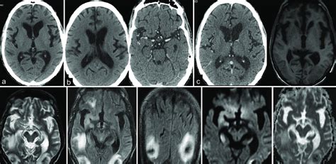 A Plain Computerized Tomography Scan Of Brain B Contrast Enhanced Download Scientific