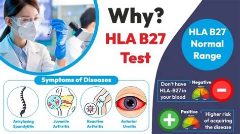 Hla B27 Test Price Range Report And Procedure