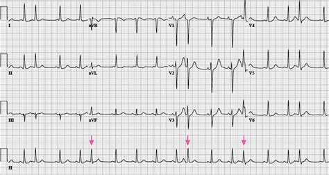 Ectopic Supraventricular Arrhythmias Ectopic Supraventricular Arrhythmias Msd Manual