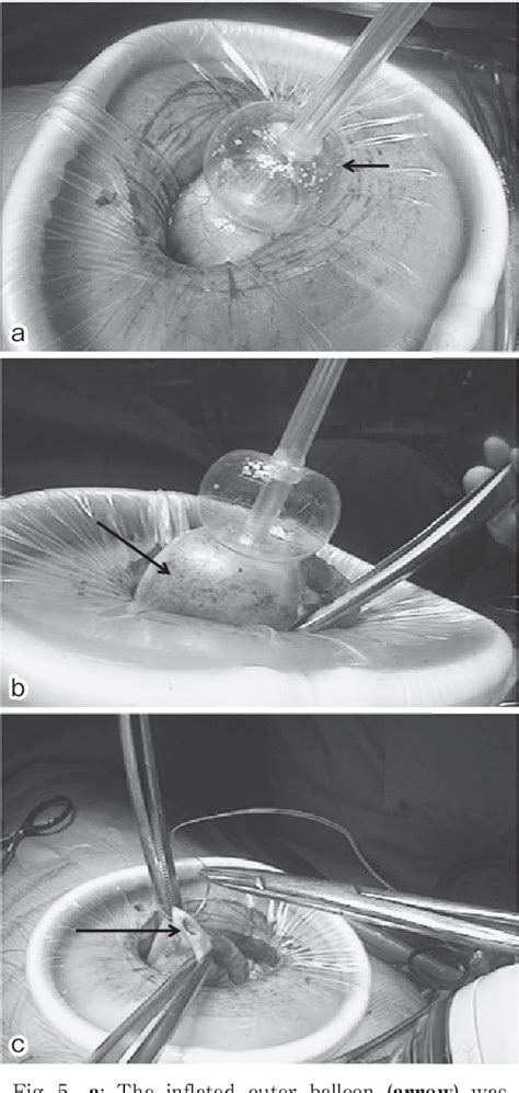 Figure 1 From Safe Technique For Laparoscopic Distal Pancreatectomy Involving A Large Cystic