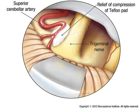 Trigeminal Neuralgia Treatment