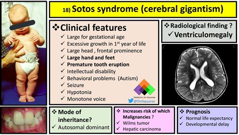 Soto Syndrome Life Expectancy Cardiovascular Concerns Cancer