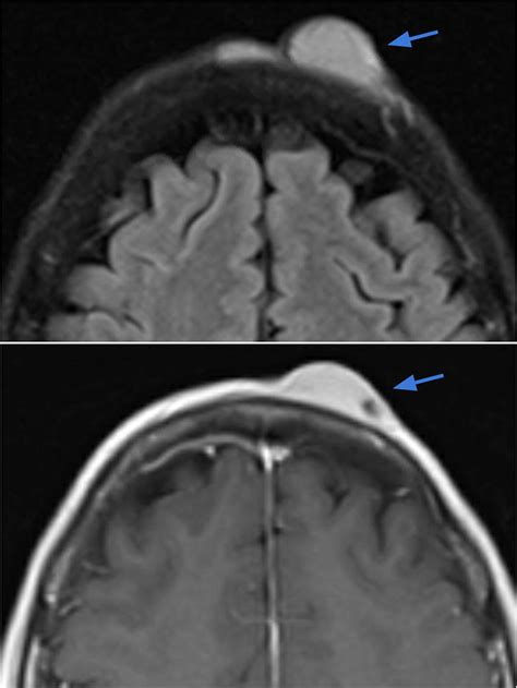 Dermatofibrosarcoma Protuberans Dfsp Of The Scalp Axial T2 Weighted Download Scientific