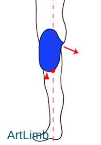 Prosthetic Alignment Part2 The Socket Artlimb