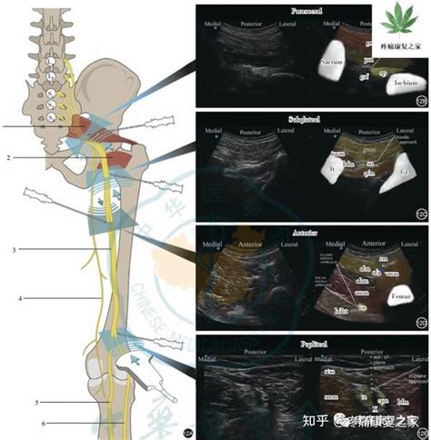 坐骨神经阻滞疗法中国专家共识（2022 版） 知乎