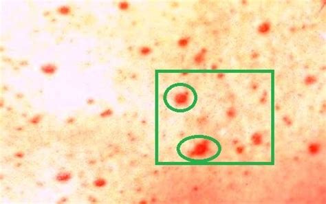 Maculopapular Rash Pictures Treatment Symptoms Causes