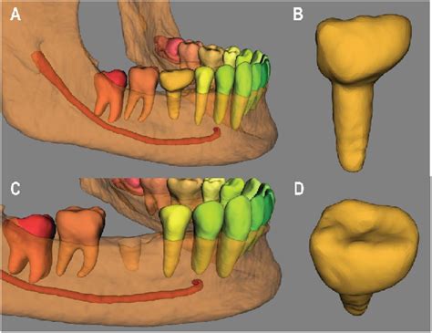 Ai Based Segmentation Of Mandibular Implant And Crown Using Virtual
