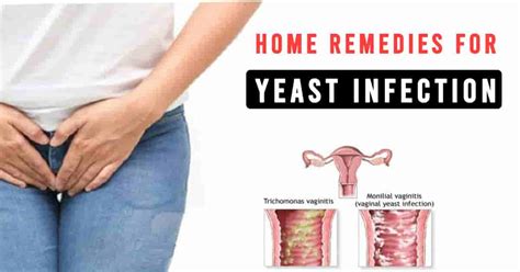 10 Easy Home Remedies For Yeast Infection Healthtostyle