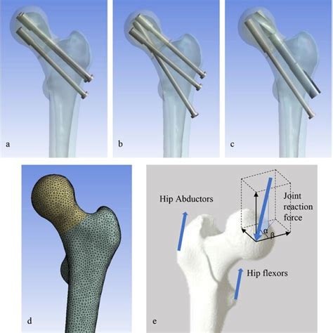 Finite Element Models Of Pauwels Type Iii Fnf With Internal Fixations Download Scientific
