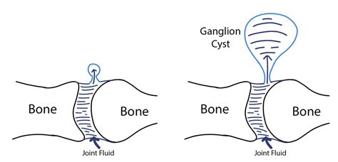 Lumps And Bumps Of The Upper Extremity Dr Nick Golinvaux