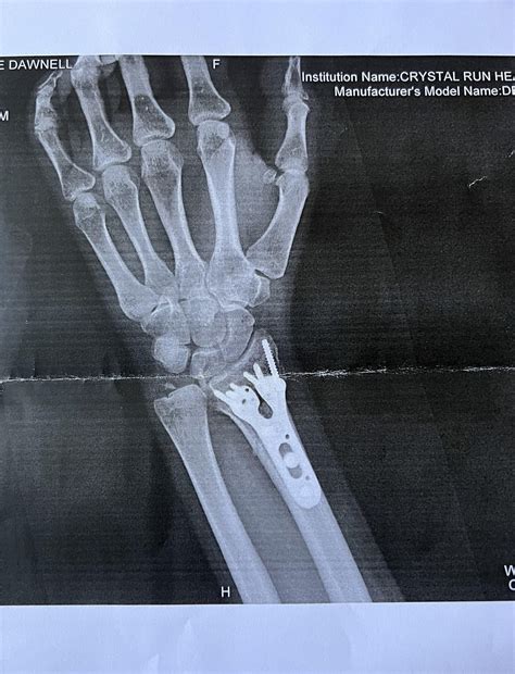 Broken Dislocated Left Wrist R Brokenbones