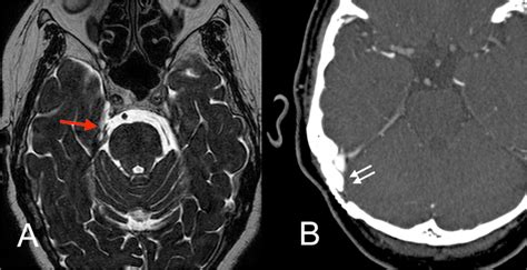 Trigeminal Nerve Mri