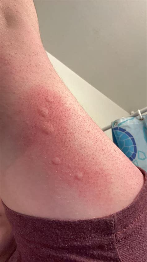Can Anyone Help Identify This Spider That Just Bit Me R Spiderbites