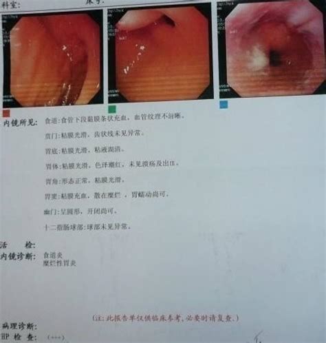 糜烂性胃炎伴幽门螺杆菌感染一列 病例中心 诊疗助手 爱爱医医学网