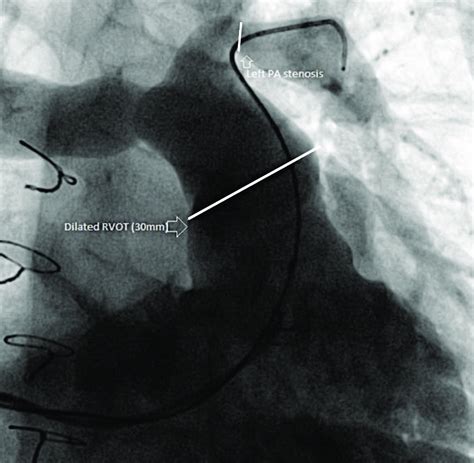 Right Ventriculography Showing The Dilated Right Ventricular Outflow