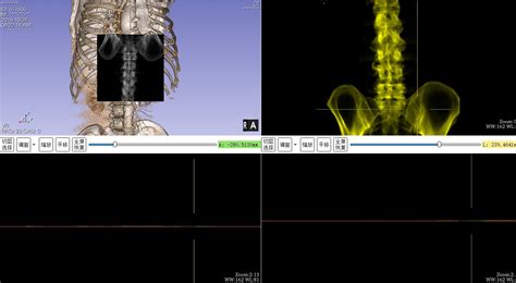 Rendering For Ct And Dsa Registration Development 3d Slicer Community