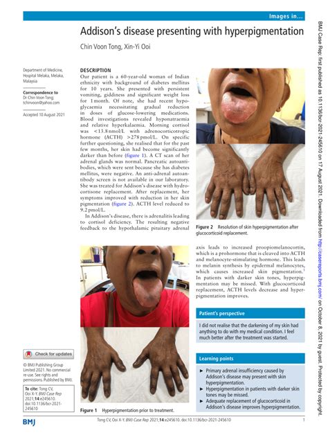 Pdf Addisons Disease Presenting With Hyperpigmentation