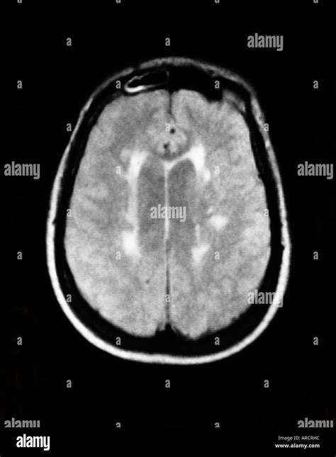 An Mri Scan Showing The Typical Demyelination Due To Multiple Sclerosis