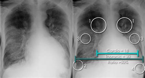 Initial Chest Xray Revealed Interstitial Pulmonary Edema