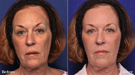 Renuva Boston Newton Waban Dr Happe Medical Aesthetics