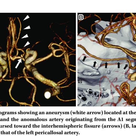 Ct Scan Demonstrating Subarachnoid Hemorrhage In The Basal Cistern
