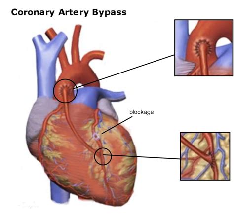 How To Plan For Bypass Surgery