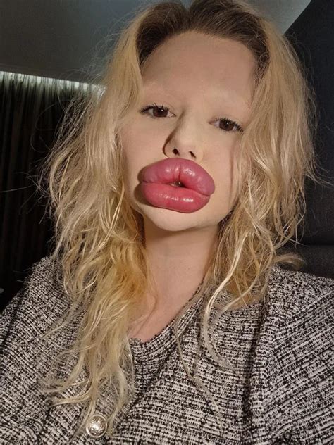 She Is Known As The Woman With The ‘worlds Largest Lips— Heres What