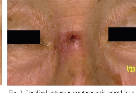 Cryptococcus Skin