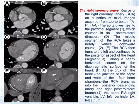 Coronary Classpptx Free Download