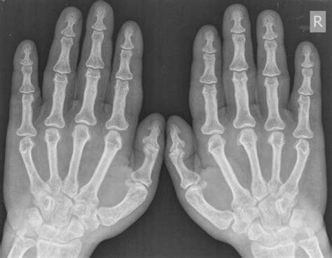 Pituitary Adenoma Causing Acromegaly Radiograph Of The Hand Showing Generalized Increased Soft