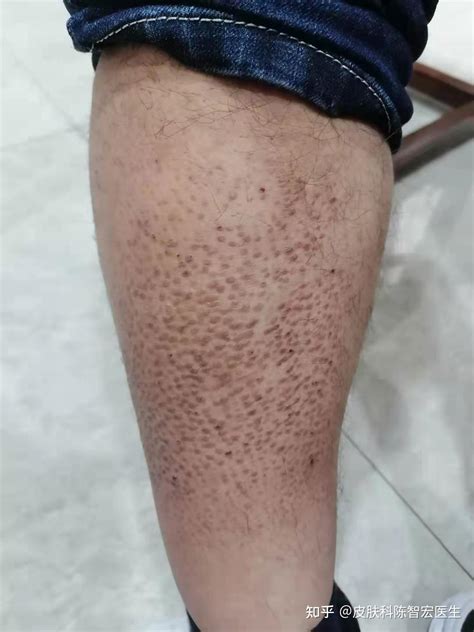 皮肤淀粉样变真的治不好了吗？是不是很多人都不知道这种病？ 知乎