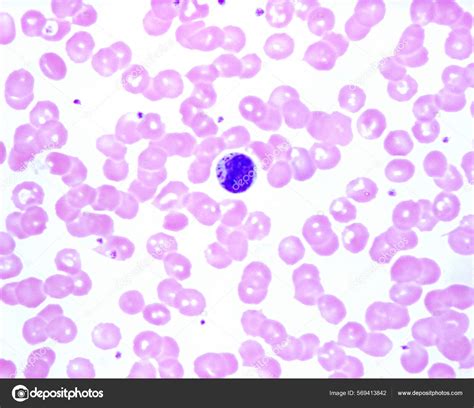Reactive Lymphocyte