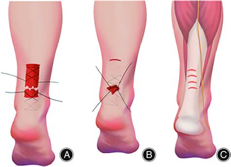 Schematic Diagrams Of The Achilles Tendon Suture And Surgical Incision Download Scientific