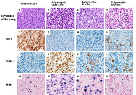 A Spectrum Of Morphologic Variants And Immunophenotypic Profiling In