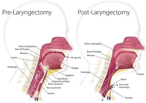 27 Best Laryngectomy Tracheostomy And Me Images On Pinterest