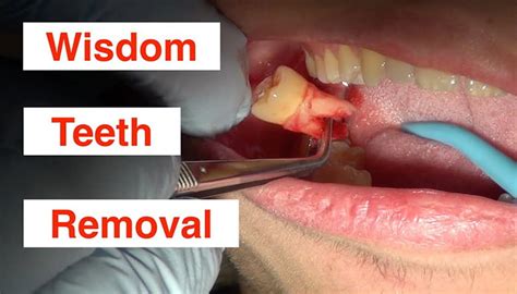 What You Should Know About Wisdom Tooth Extraction Pain