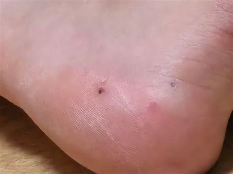 발 뒤꿈치에 검은 점 지식in