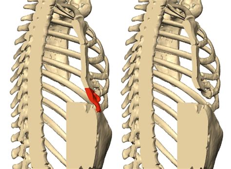 Pectus Implants Pectus Clinic