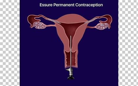 Essure Birth Control Sterilization Intrauterine Device Copper Iuds Png
