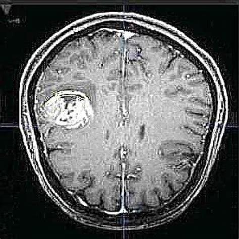 Brian Tumor Object Detection Dataset V2 2024 03 24 3 05pm By Fate52