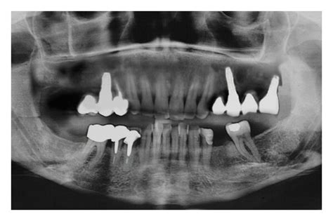 Panoramic X Ray After The Intervention Download Scientific Diagram