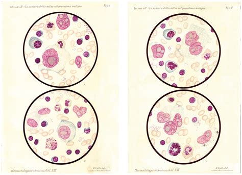 Reed Sternberg Cells